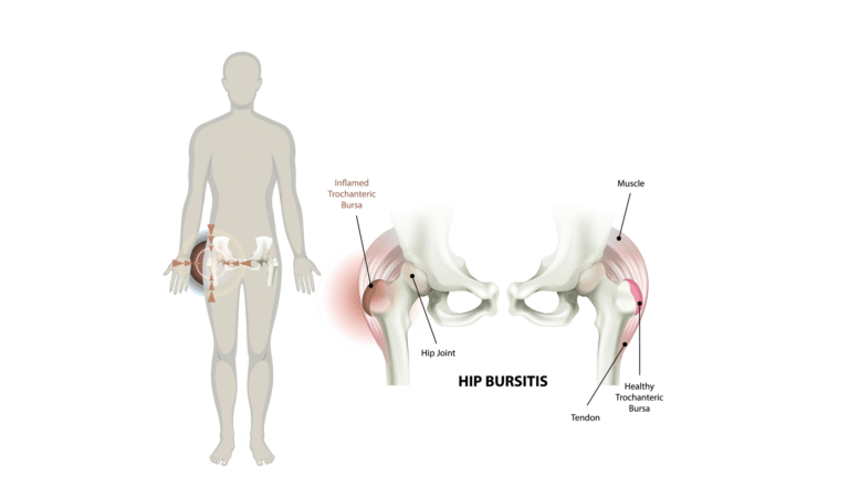 Is Chiropractic Effective for Hip Bursitis (Trochanteric Bursitis)?